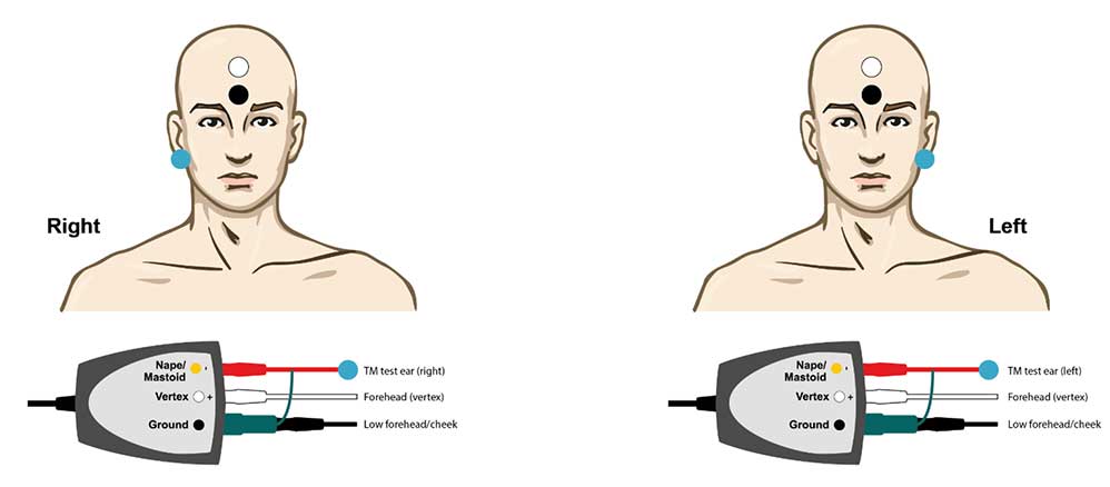 Eclipse | Cochlear Microphonics | Interacoustics